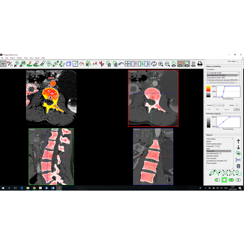 Medviso Segment 3D Print - Laser Lines
